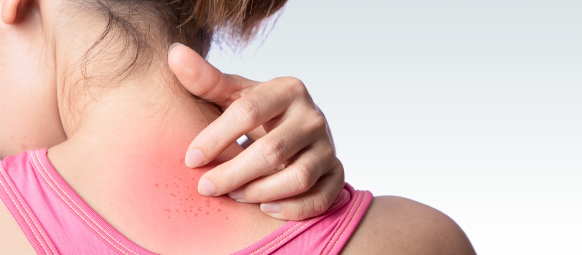 Ihottuma – oireet ja hoito | Itsehoitoapteekki