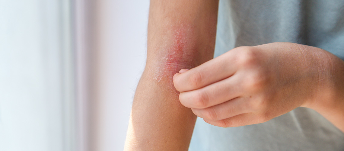 Atooppinen ihottuma lapsella – näin hoidat | Itsehoitoapteekki